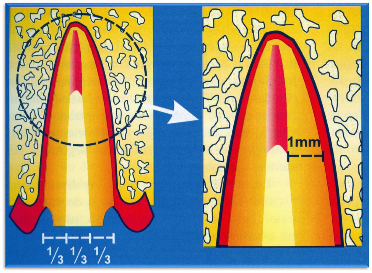Odontologia: Retentores Intra-radiculares