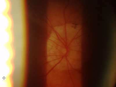 Sonoran Desert Eye Center: PERIPAPILLARY ATROPHY