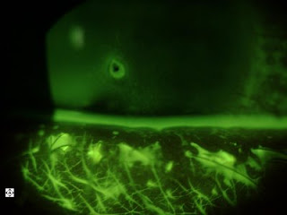 Sonoran Desert Eye Center: METALLIC FOREIGN BODY