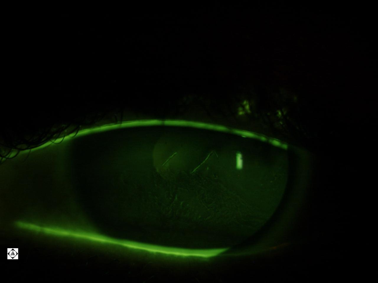 Sonoran Desert Eye Center: CORNEAL SCRATCHES