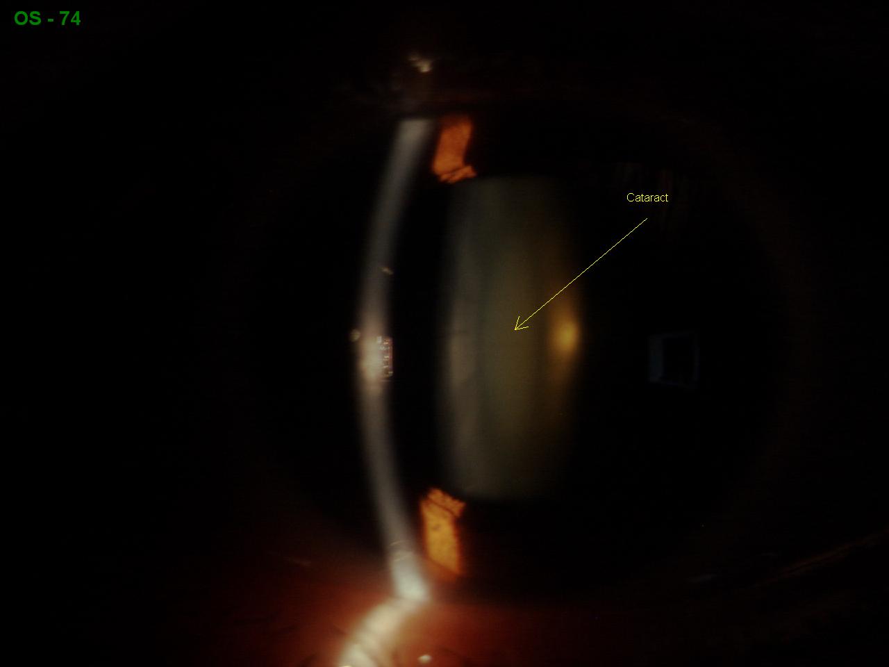 Sonoran Desert Eye Center: NUCLEAR CATARACT