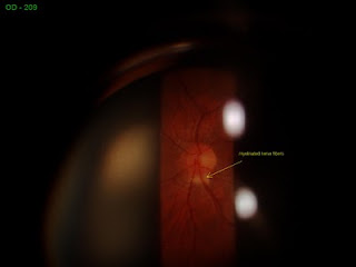 Sonoran Desert Eye Center: MYELINATED NERVE FIBERS AND VITREORETINAL TUFT