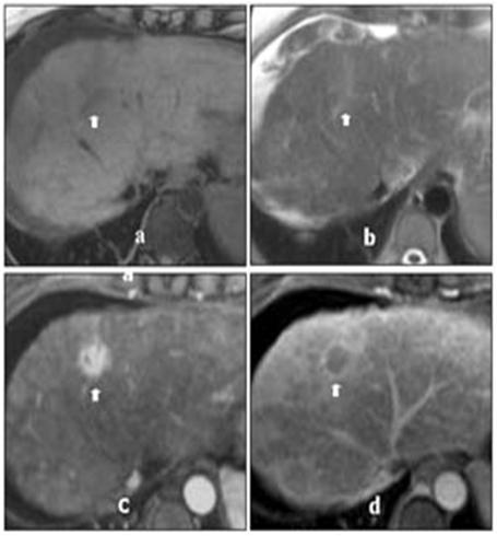 CARCINOMA HEPATOCELULAR: CARCINOMA HEPATOCELULAR