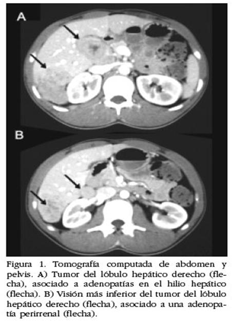 CARCINOMA HEPATOCELULAR: CARCINOMA HEPATOCELULAR