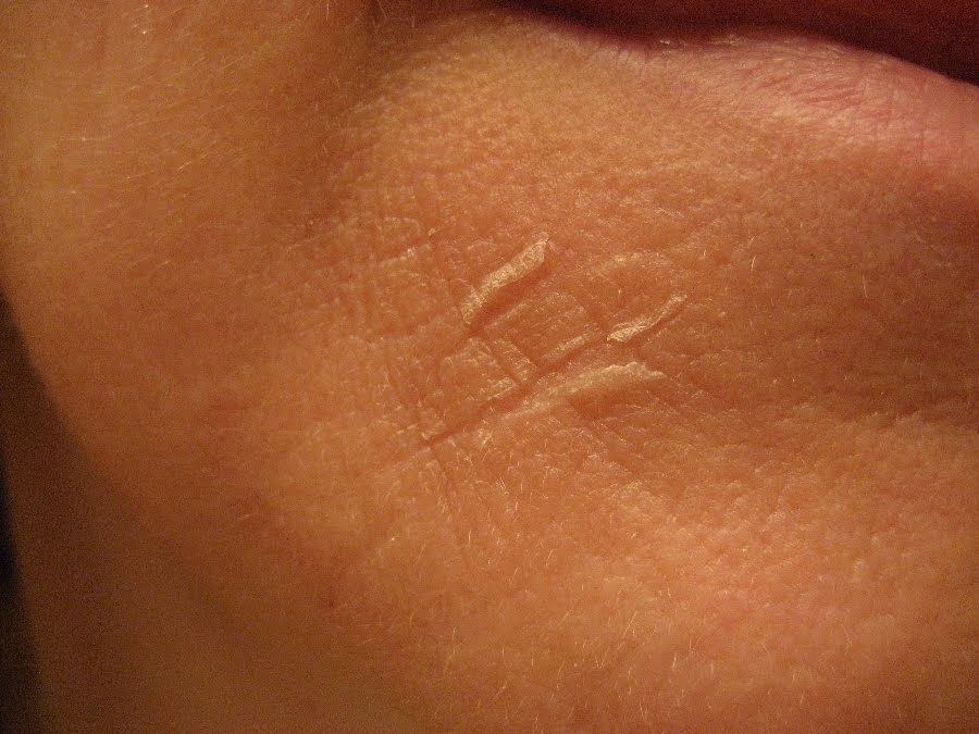 Chemical Peels For Acne And Anti Aging First Tca Facial Peel Day 3