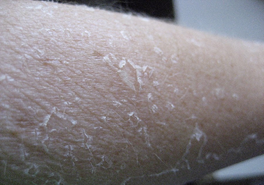 Chemical Peels for Acne and Anti Aging: TCA Peel Arms - Day 6