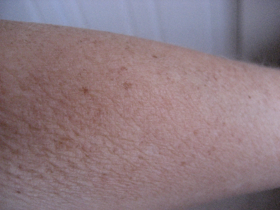 Chemical Peels For Acne And Anti Aging Tca 50 Chemical Peel Before And After Pictures