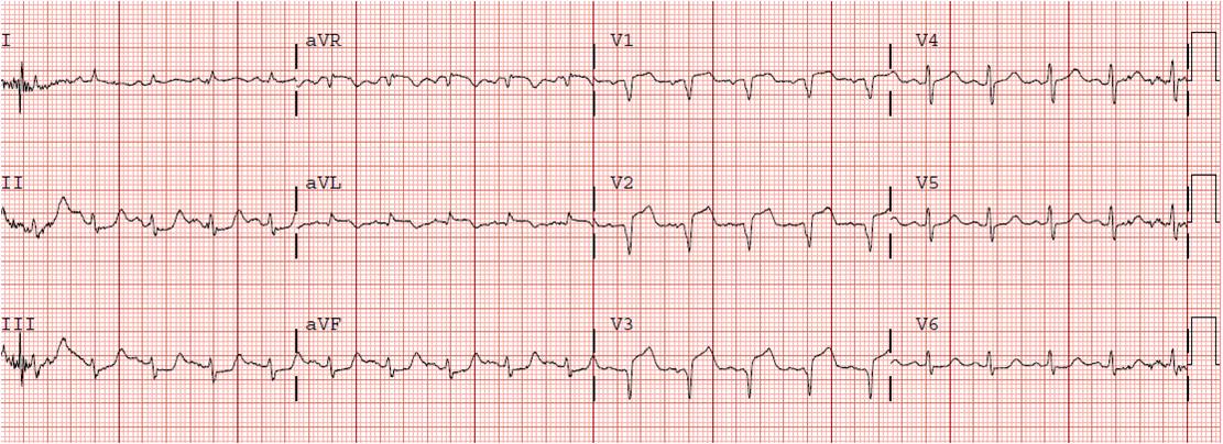 Dr. Smith's ECG Blog: Progression of Anterior STEMI with RBBB and ...