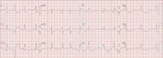Dr. Smith's ECG Blog: STEMI best seen in PVC