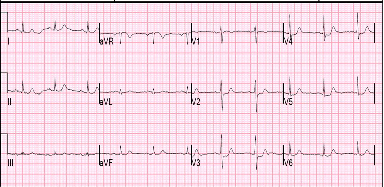 Dr. Smith's ECG Blog: Pure Posterior STEMI, not a rare event