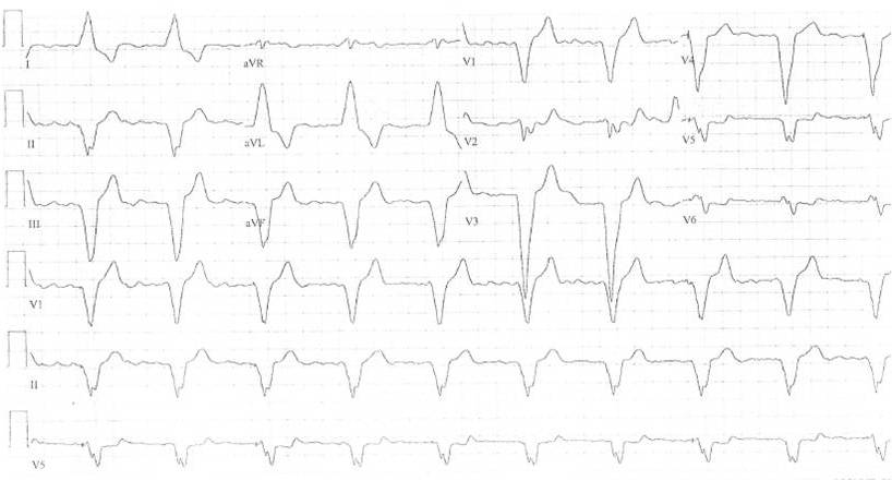 Dr. Smith's ECG Blog: LAD occlusion in the setting of paced rhythm