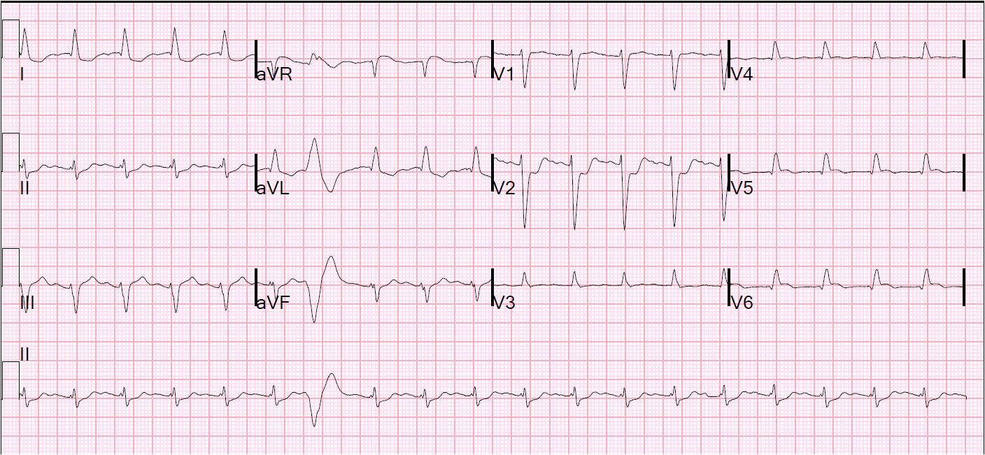 Dr. Smith's ECG Blog: Incomplete LBBB, posterior STEMI, posterior leads ...