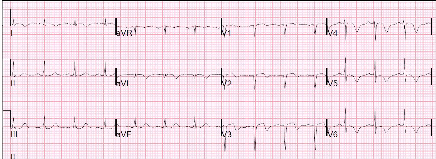 Dr. Smith's ECG Blog: Hyperacute T-waves, missed by computer, short DBT ...
