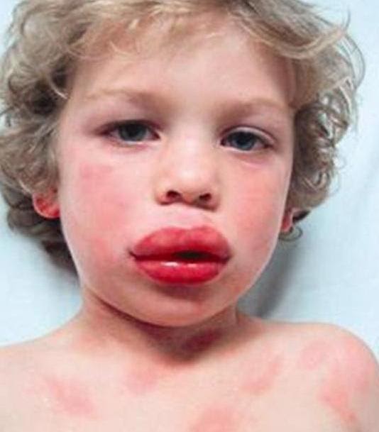 ANAESTHESIA TODAY: ANAPHYLAXIS THE EXTREME HYPERSENSITIVITY!