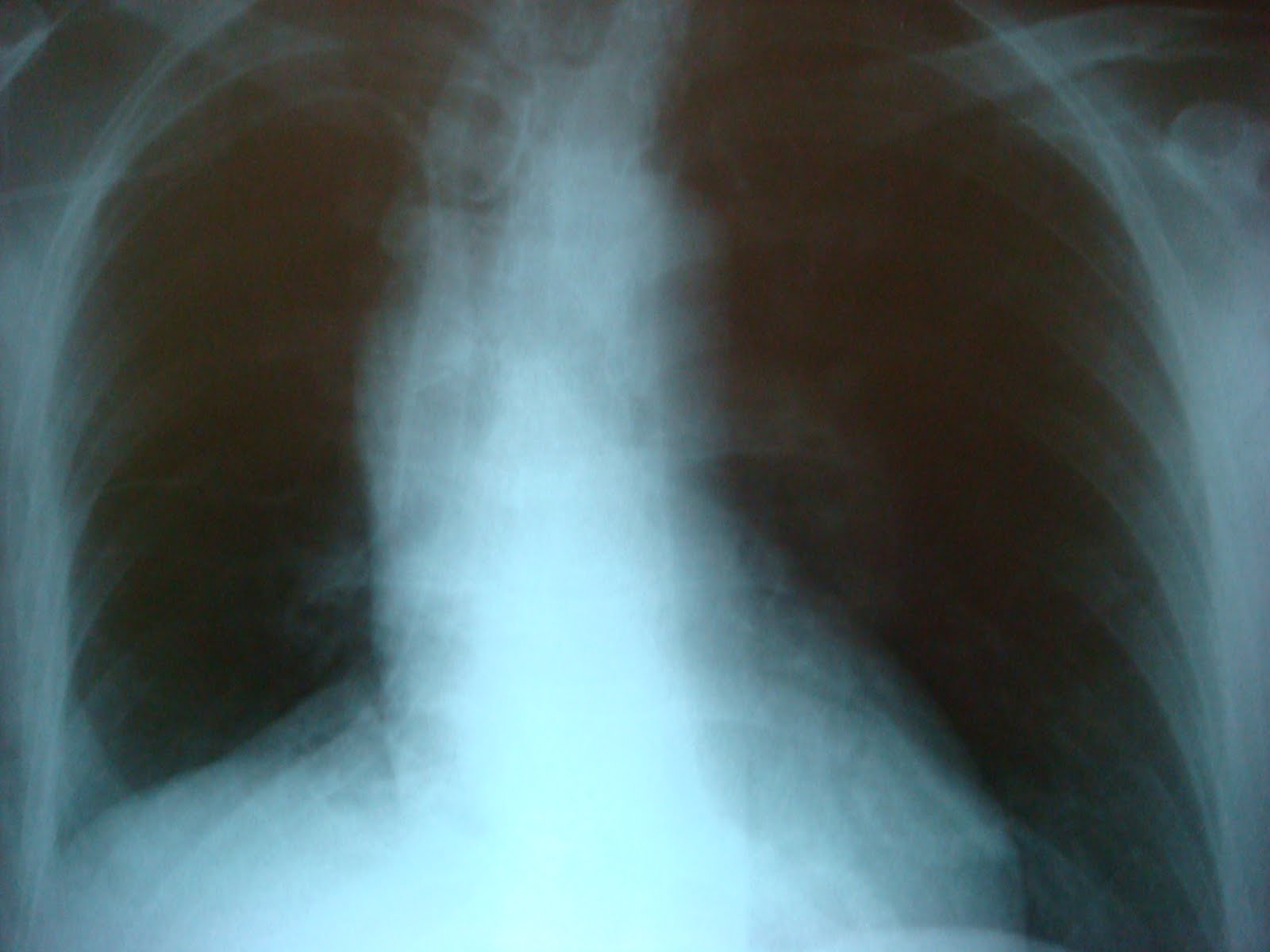 Cirurgia Torácica / Thoracic Surgery - Dr. Alexandre Avino: Right lower ...