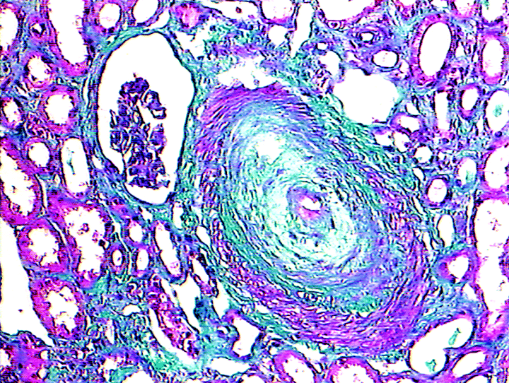 Nephron Power: CONSULT ROUNDS: Post Bone Marrow Transplant Thrombotic ...