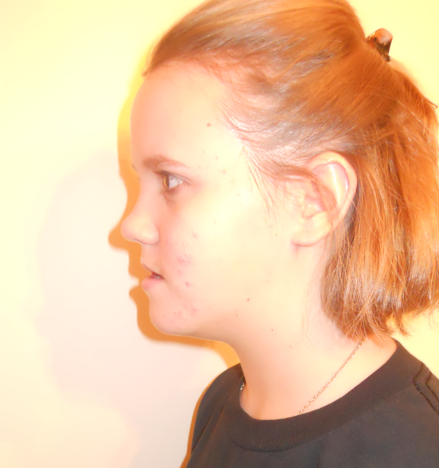 Brynne's LeFort 1 Osteotomy Surgery: Side Open Bite