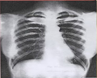 TEKNIK RADIOGRAFI THORAX ~ RADIOLOGI