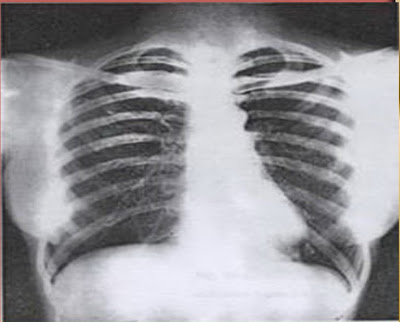 TEKNIK RADIOGRAFI THORAX - Radiografer