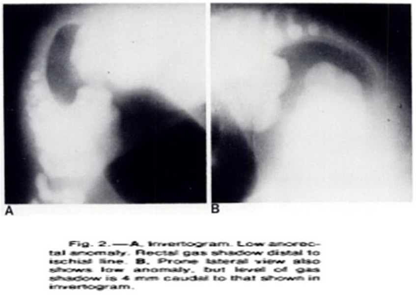 Teknik Radiografi Pada Kasus Atresia Ani ~ Catatan Radiograf