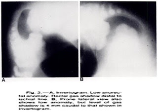 RADIOGRAFER WORLD: Teknik Radiografi Pada Kasus Atresia Ani