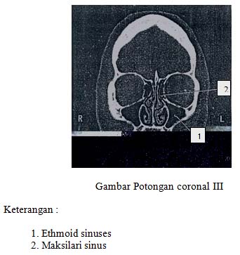 RADIOGRAFER WORLD: Teknik Pemeriksaan CT-Scan Sinus Paranasal