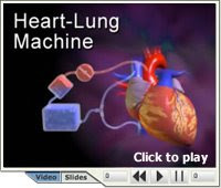 HEALTH CARE: Heart Lung Machine