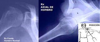 UNT PRACTICOS DE TRAUMATOLOGÍA: Práctico de Hombro