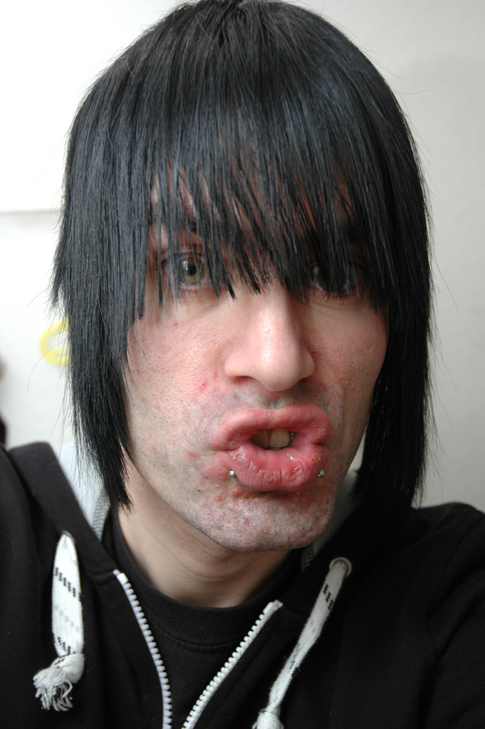 Acne Around Mouth acne-around-mouth