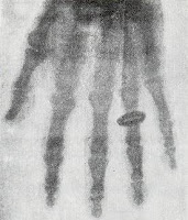APRENDIENDO: PRIMERA RADIOGRAFIA DE ROENTGEN