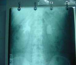 APRENDIENDO: UROGRAMA EXCRETOR - UROGRAFÍA E.V. O INTRAVENOSA ...