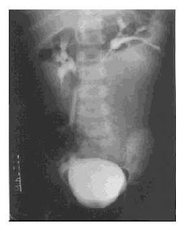 APRENDIENDO: UROGRAMA EXCRETOR - UROGRAFÍA E.V. O INTRAVENOSA ...