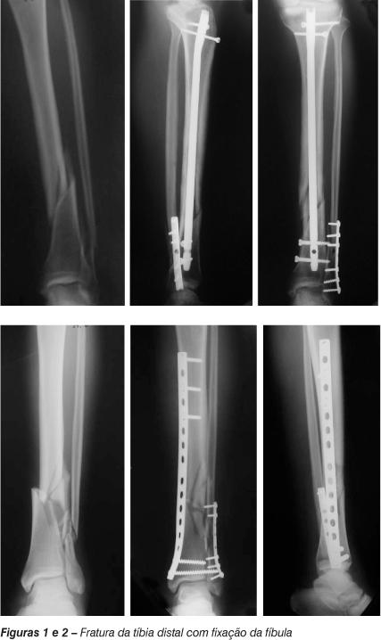 Fisioterapeuta Luís Miguel Brazão Gouveia: Reabilitação de Fracturas da ...