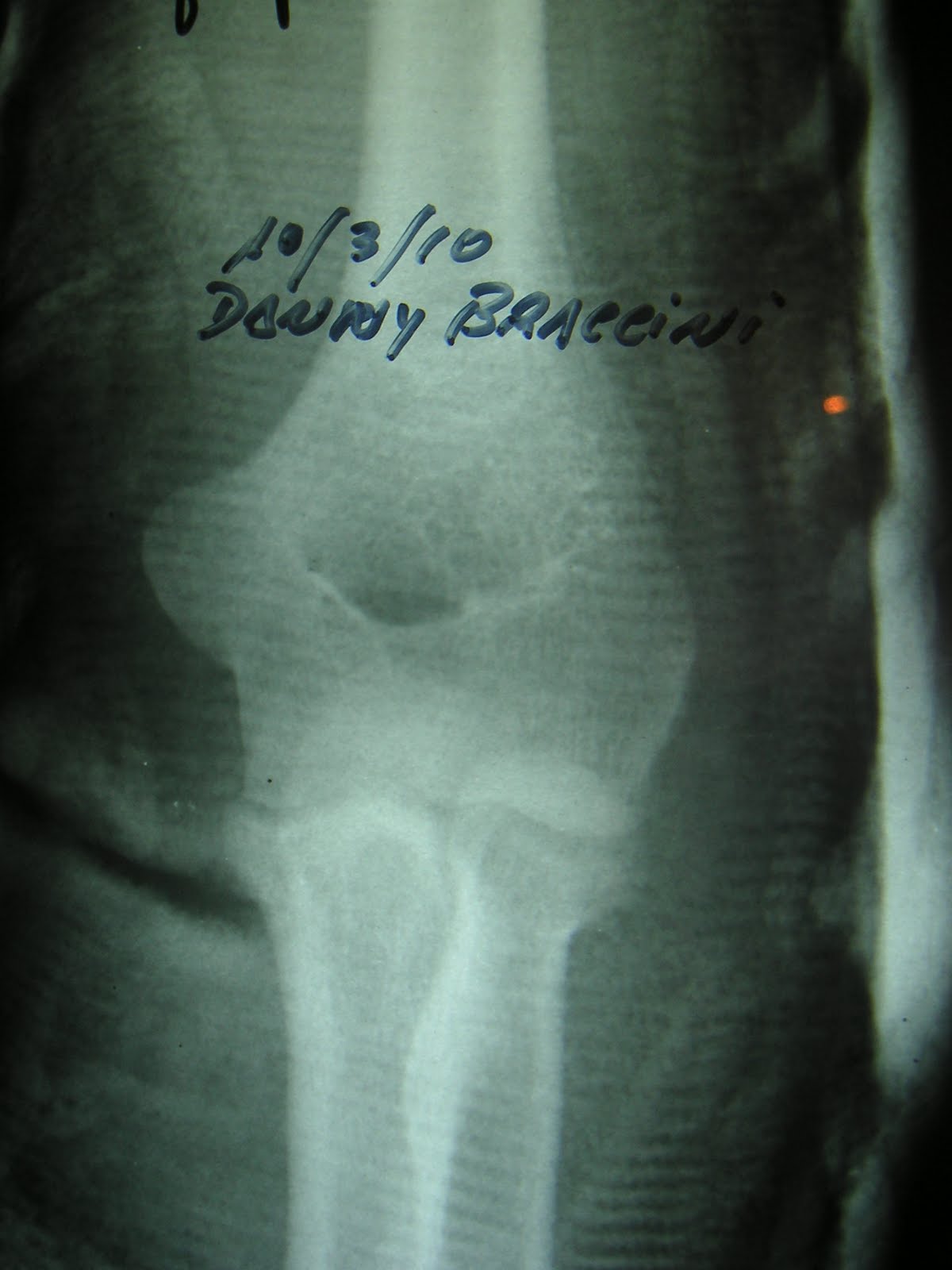 Orthophaedic and Traumatology Surgery.: POLITRAUMATIZADO SEVERO ...