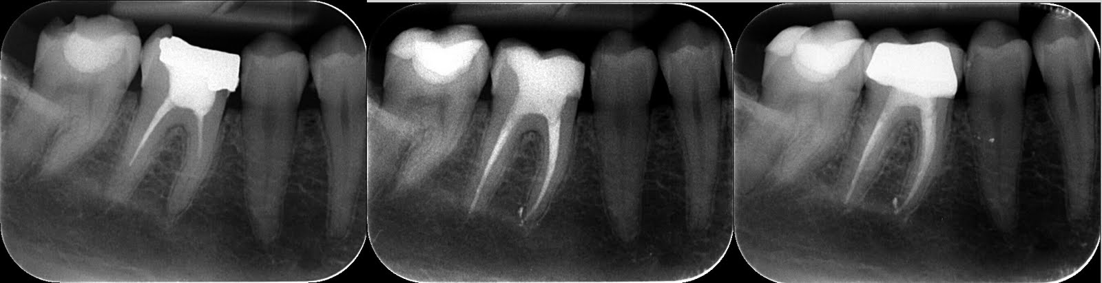 Clinica Omega: Reendodoncia y corona