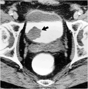 RadiologySpirit: pedunculated urinary bladder carcinoma