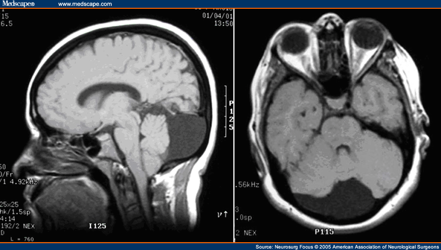 RadiologySpirit: Arachnoid cyst