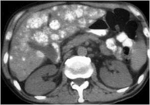 RadiologySpirit: hepatic metastases(calcified).