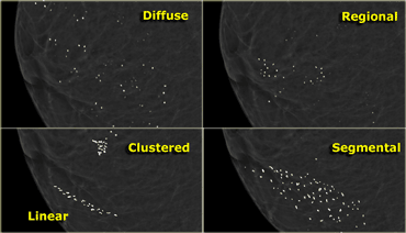 RadiologySpirit: BI-RADS AND CALCIFICATION(FIGURES)