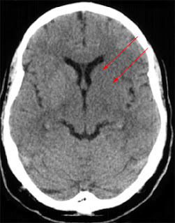 RadiologySpirit: Cerebral Stroke