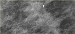 RadiologySpirit: BI-RADS AND CALCIFICATION(FIGURES 2)