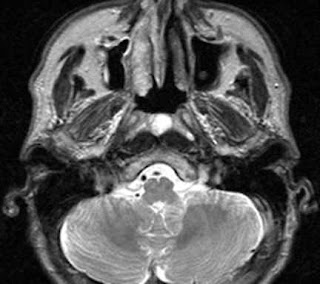 RadiologySpirit: Thornwaldt Cyst