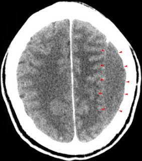 RadiologySpirit: Subacute Subdural Hematoma