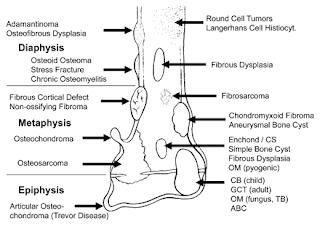 RadiologySpirit: Osteomyelitis