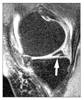 RadiologySpirit: Meniscal Tears