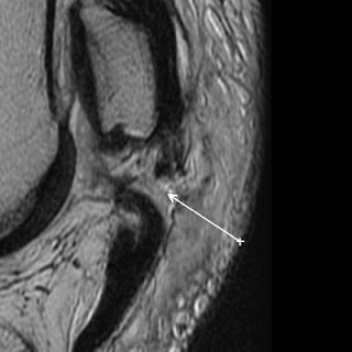RadiologySpirit: Patellar tendon tear