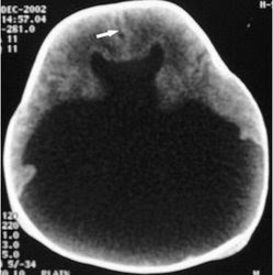 RadiologySpirit: Holoprosencephaly