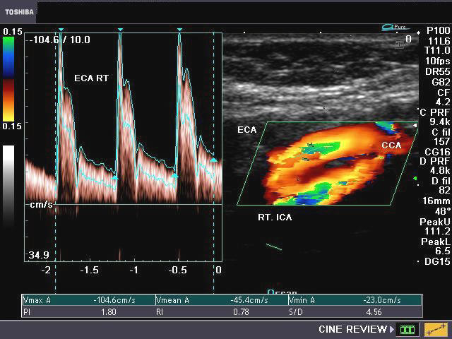 RadiologySpirit: Doppler waveform of normal ECA (External carotid artery):