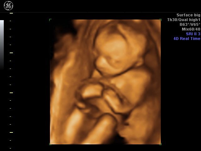 RadiologySpirit: Fetal club hand deformity: