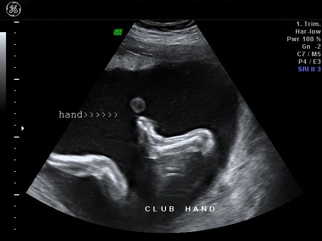 RadiologySpirit: Fetal club hand deformity: